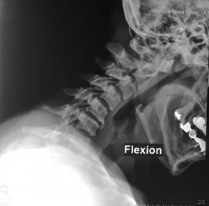 Spinal Bio-mechanical Dysfunction; Inter-segmental Dysfunction – Dr ...
