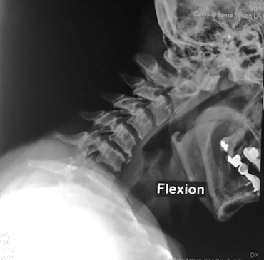 Spinal Bio-mechanical Dysfunction; Inter-segmental Dysfunction – Dr ...