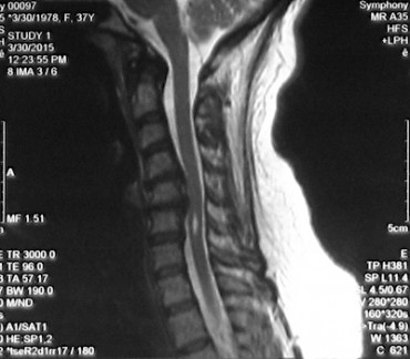 Syringomyelia / Hydromyelia; Chiropractic Management – Dr. Hossein Sabbagh