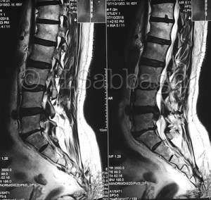 Lumbar Foraminal Stenosis; DPPP-SAA Decompression Protocol (Synopsis ...