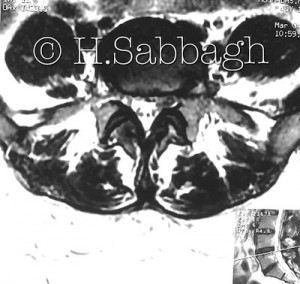Syringomyelia / Hydromyelia; Chiropractic Management – Dr. Hossein Sabbagh
