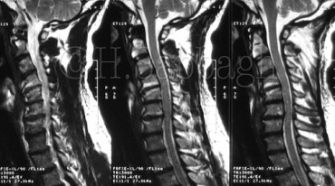 Spinal Modic Changes – Diagnostic Imaging Considerations & Clinical ...