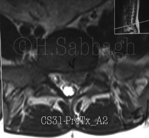 Right Paracentral L5-S1 Herniation – Lateral Recess Compromise ...