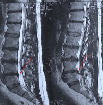 L4-5 Posterior Central Left Outer Annular Herniation – Acute Moderate ...